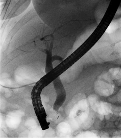 Transcystic Tube Cholangiogram Download Scientific Diagram