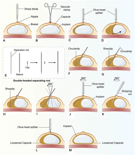 Breast Surgery Capsular Contracture Causes And Soluti