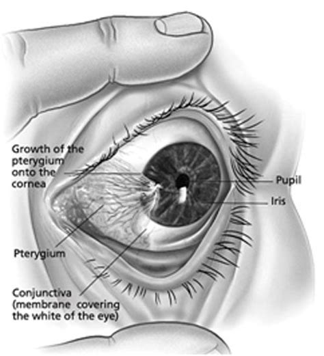 Pterygium Surgery Opthalmologist Gold Coast