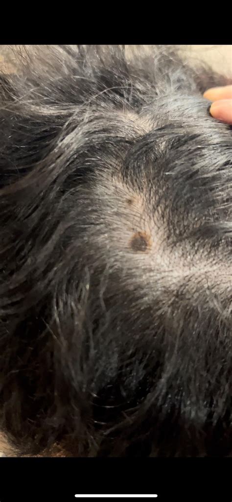 Mole Looks Weird Could It Be Cancerous Rmedical
