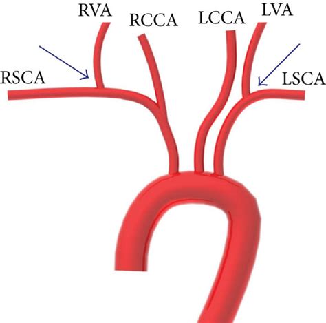 Rva Right Vertebral Artery Rcca Right Common Carotid Artery Lva