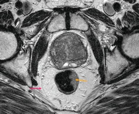 Peritoneal Reflection Mri