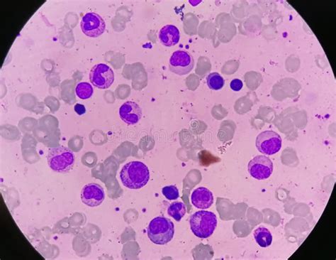 Bone Marrow Study Dimorphic Erythroid Hyperplasia Stock Image Image