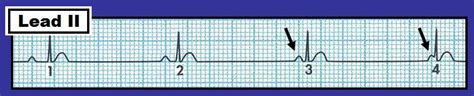 Ecg Interpretation Ecg Interpretation Review 21 Complete Av Block Vs