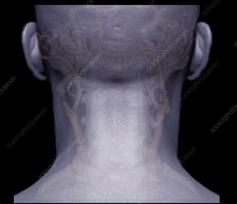 Atherosclerosis In Neck Arteries 3d Ct Scan Stock Image C0388550