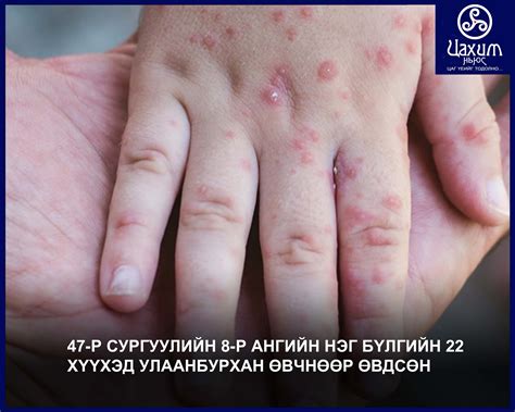 Tsahim Нийслэл хотод Улаанбурхан өвчний тохиолдол эрс нэмэгдэж байгаатай холбогдуулан иргэд