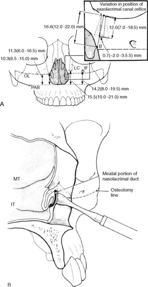 MAXILLARY OSTEOTOMIES LE FORT I OSTEOTOMY Pocket Dentistry