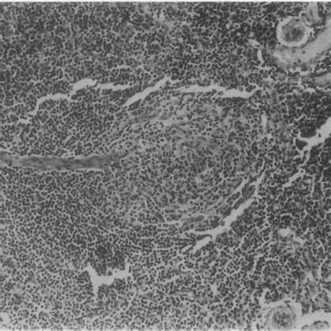 Biopsy Specimen From The First Lymph Node Showing Hyperplastic