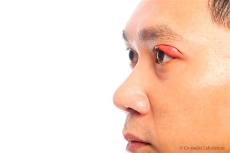 Orzuelos En Los Ojos Causas Prevención Y Soluciones Caseras