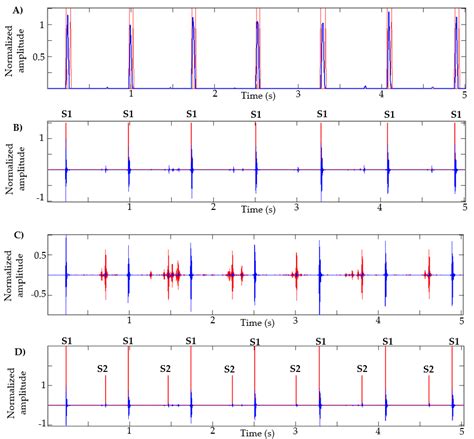 Automatic Segmentation And Classification Of Heart Sounds Using Modified Empirical Wavelet
