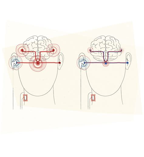 New Tinnitus Treatment Bimodal Neuromodulation Targets The Brain Washington Post
