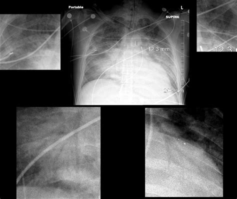 Lungs Air Bronchogram Cxr The Common Vein