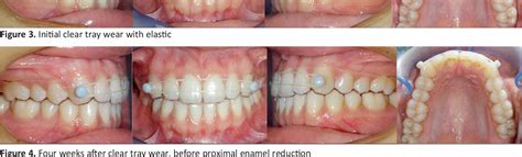 Figure 3 From Treatment Of Maxillary Midline Diastema Using Removable Clear Trays And Elastics