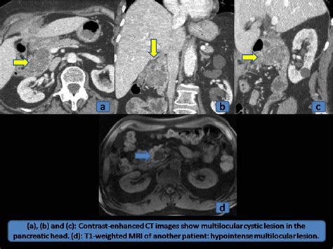 Figure 2 From Radiologic Endosonographic Correlation Of Cystic