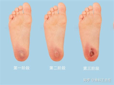 中老年人脚后跟干裂不疼不痒是糖尿病的征兆吗 知乎