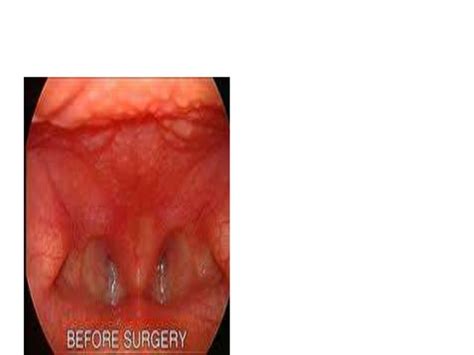 Choanal Atresia Pptx