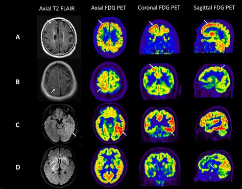 The Correlation Of T2 Flair Findings With¹⁸ F Fdg Pet Features In