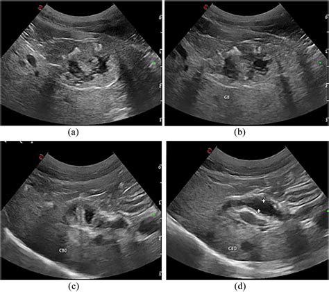 Gallbladder Adenoma In A Domestic Shorthair Cat