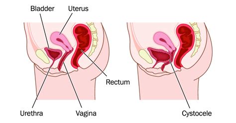 Pelvic Organ Prolapse And Exercise Is It Safe Girls Gone Strong