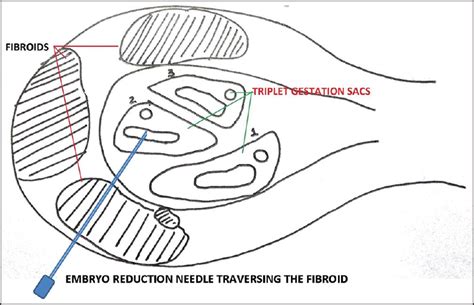 Embryo Reduction In A Myomatous Uterus And Polypectomy During Embryo