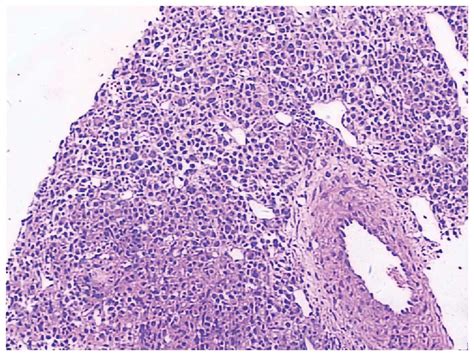 Compression Fracture Histology At Juan Borger Blog