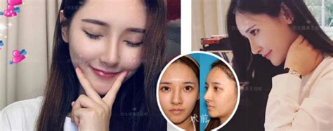 线雕伪综合，2次隆鼻失败修复后，肋软骨鼻整形修复案例分享 知乎