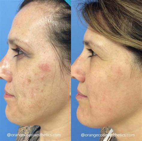 Erbium Laser Resurfacing Uk Store Deborahsilvermusic