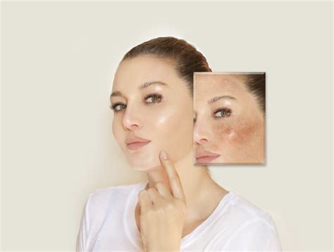 Como Tirar Melasma Do Rosto Tudo O Que Você Precisa Saber