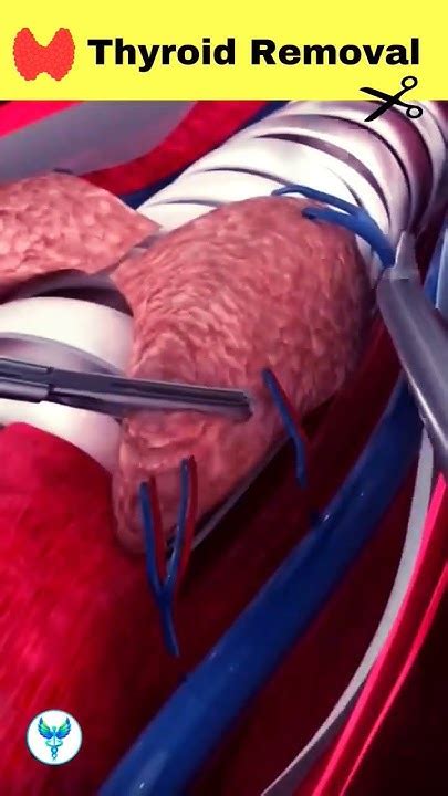 Thyroid Gland Surgery 3d Animation Of Thyroid Gland Shorts Asmr