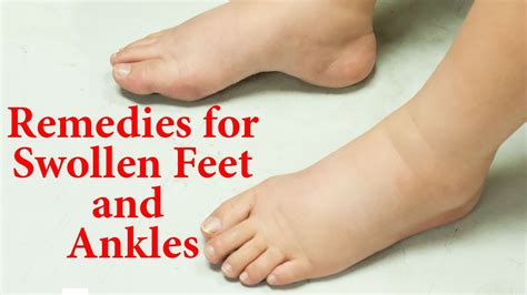 Home Remedy For Swollen Ankles Legs Homemade Ftempo