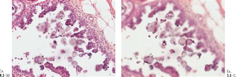 Overview Of The Diagnostic And Management Problems Encountered When Malignant Type
