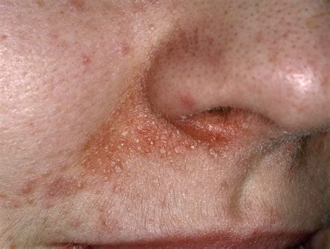 14 Causes Of A Pimple Like Rash
