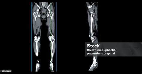 A Ct Venogram Of The Leg Is A Noninvasive Imaging Procedure Offering Detailed Visuals Of Leg