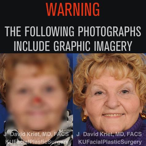 🛑🤚🏼graphic Content In The Following Photos Patient With Nasal Defect