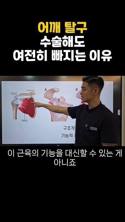 어깨 탈구 수술해도 여전히 빠지는 이유 Youtube