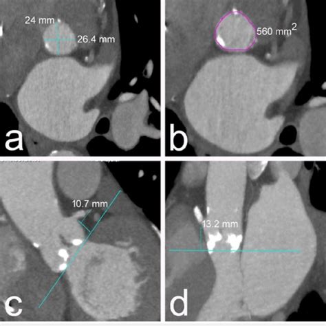 Preprocedural Ct Evaluation Ct Computed Tomography Download