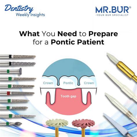 Pontic Patient Preparation Essential Steps For Optimal Dental Restora Mr Bur