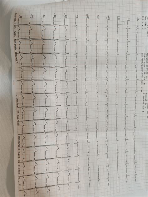 Is This Ecg Normal Raskmedical