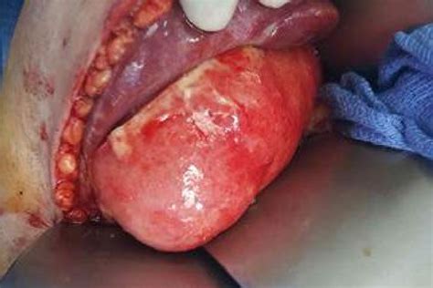 Peroperative Image Of Distended Gallbladder Download Scientific Diagram