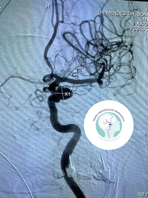 Aneurisma Cerebral Es Terapia Endovascular Neurológica
