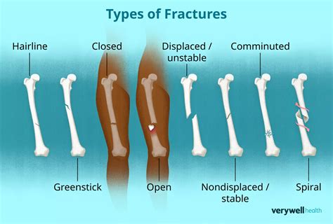 Injury Settlements For Fractures Crush Injuries And Dislocations Genthe Law Firm P C