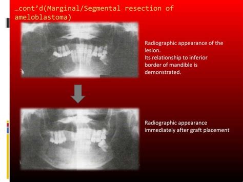 Resection Oral Surgery Very Simplified Ppt