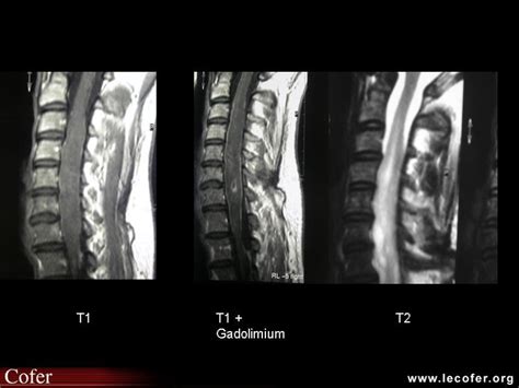Astrocytome cervical Diapothèque du COFER