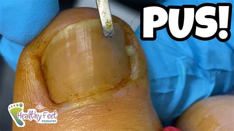 Pus Pop Satisfying Youtube