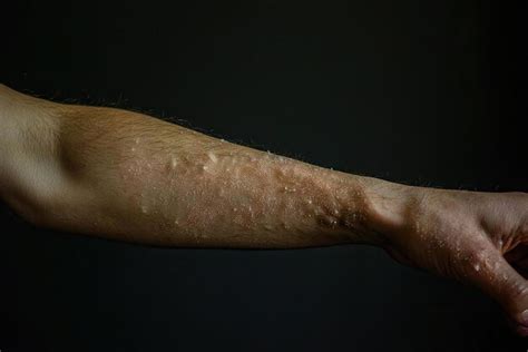 Closeup Of Eczema Rash On Arm Skin Condition With Blisters And Redness