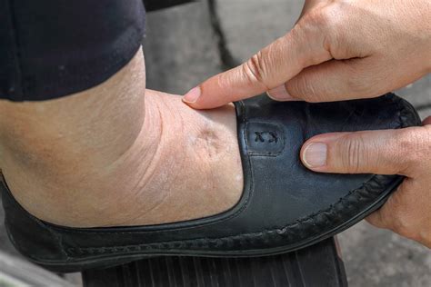 Ankle Discoloration Understanding Dark Circles Around The Ankles