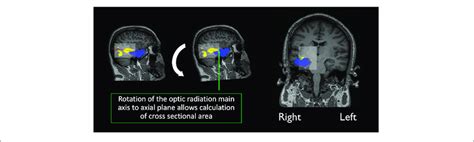 Calculation Of The Overlap Score Yellow Indicates The Optic Download Scientific Diagram