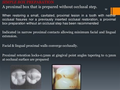 Class Ii Amalgam