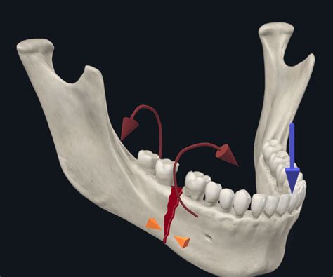 Open Reduction And Internal Fixation Of Mandibular Body And