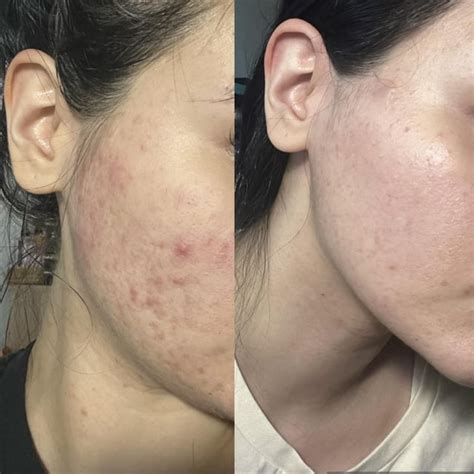 1 Month Progress Rskincareaddiction